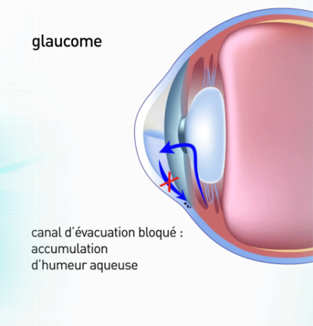Le glaucome - Chirurgie du glaucome avec le Dr Alain Amoussouga